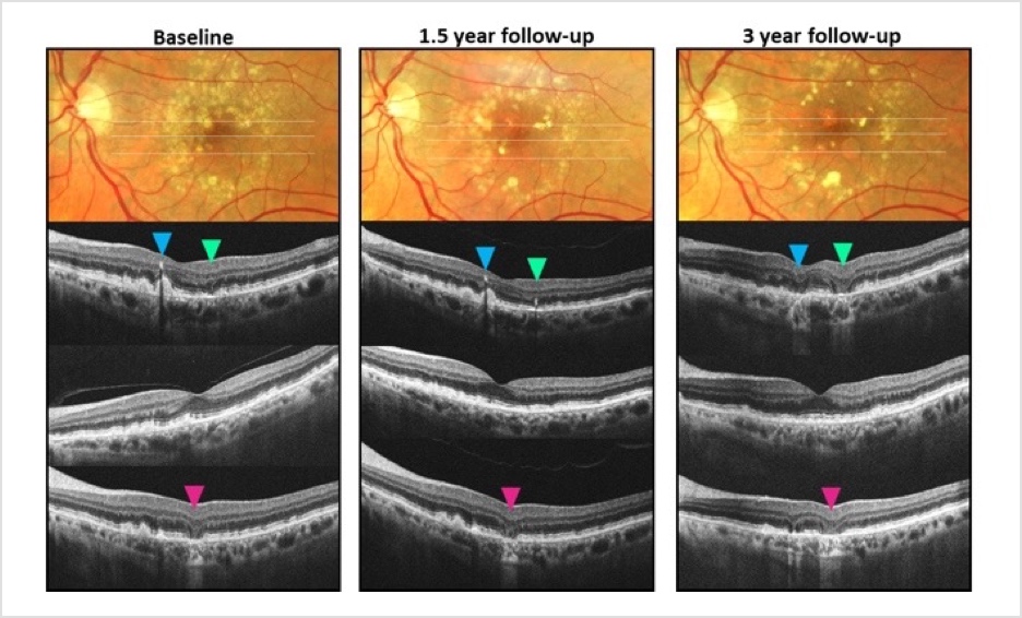 GA Case Compendium: Identifying High-Risk Biomarkers for Geographic ...