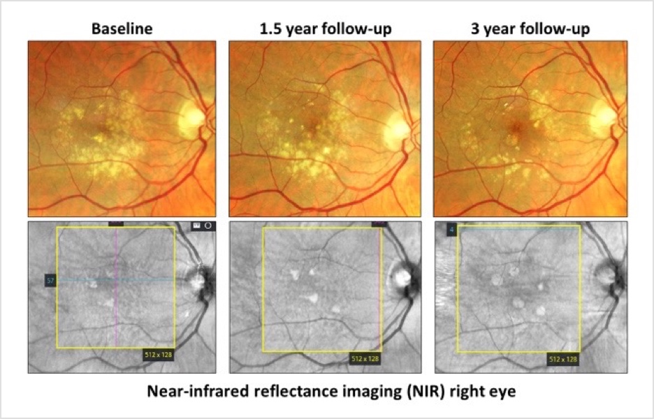 GA Case Compendium: Identifying High-Risk Biomarkers for Geographic ...