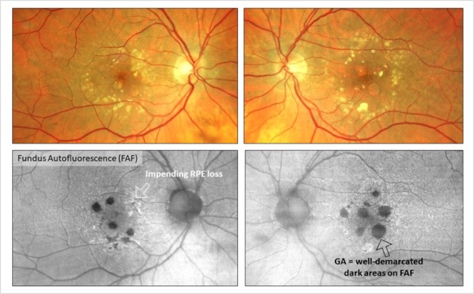 Ga Case Compendium Identifying High Risk Biomarkers For Geographic Atrophy Development And