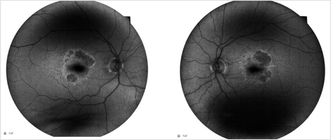 GA Case Compendium: The Optometrist as Advocate for the Patient with ...