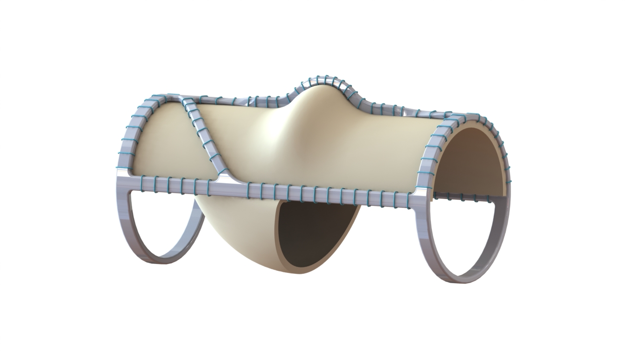 Hancock Jaffe’s Surgical VenoValve for Treating Chronic Venous ...