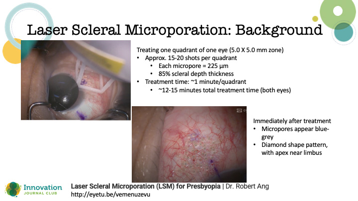 Innovation in Presbyopia Management - Glaucoma Today