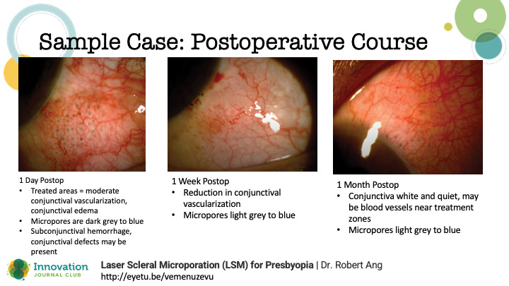 An Inside Look at Innovations in Ophthalmology: Real-World Data on MIGS ...