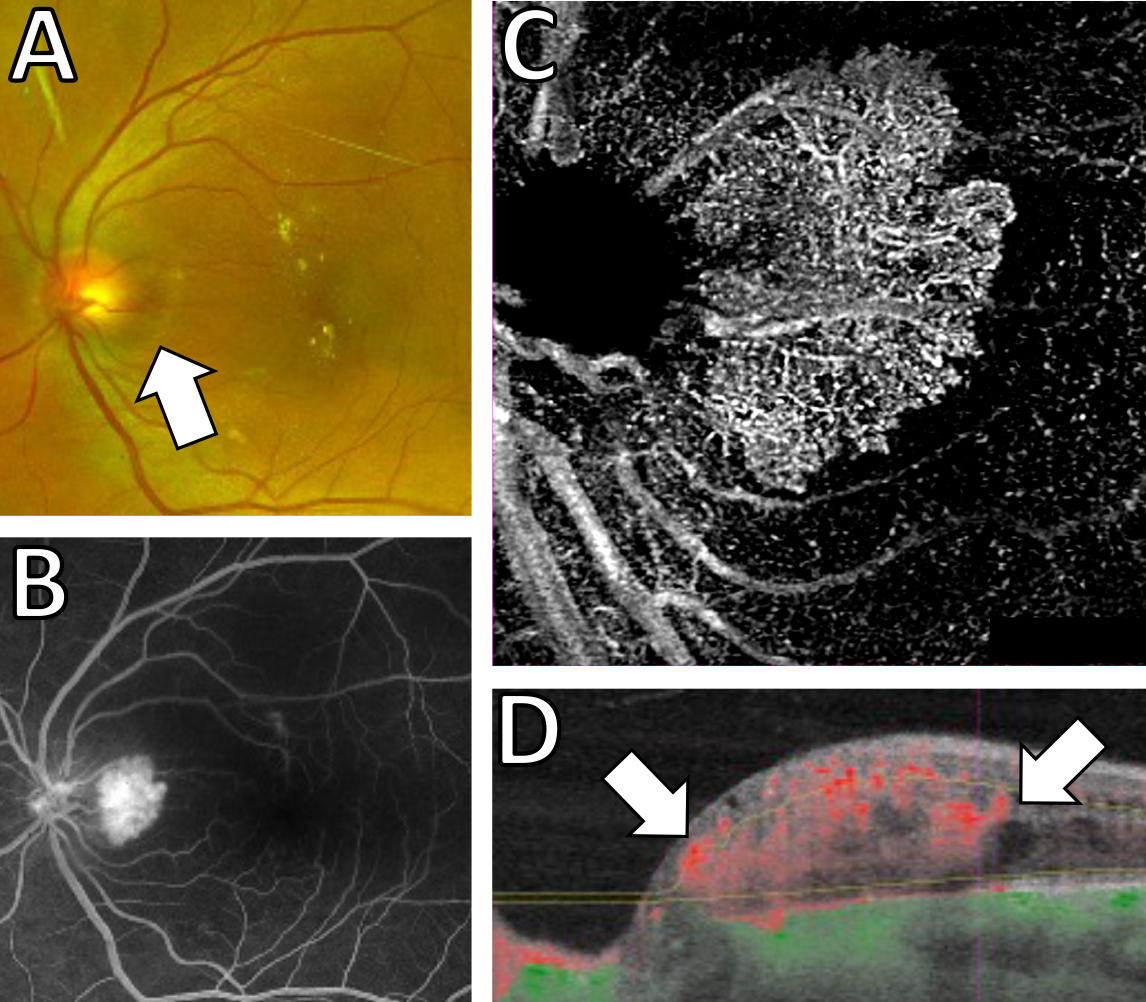 Diagnosing Exophytic Retinal Capillary Hemangioblastoma - Retina Today
