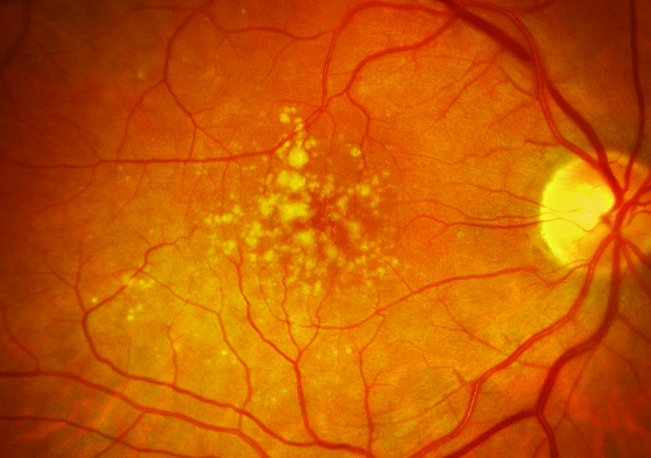 Intermediate AMD Identified: Now What? - Modern Optometry