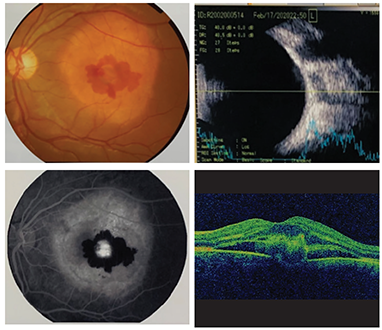 Macular Choroidal Osteoma - Retina Today