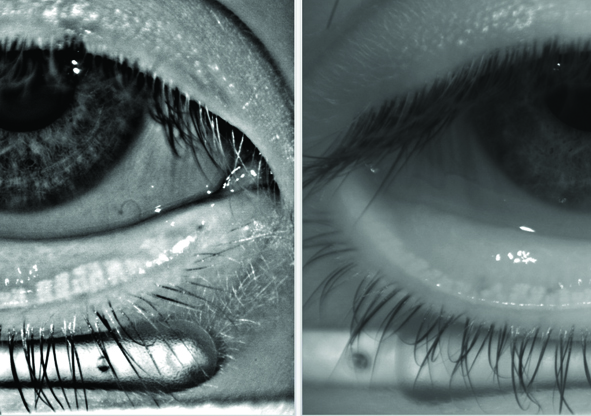 Meibography 101 - Modern Optometry