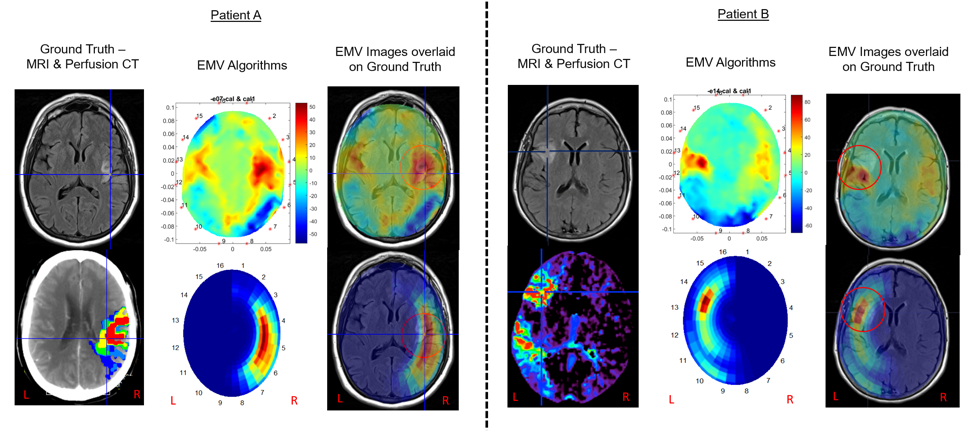 Portable Brain Imaging System Shows Promise for Stroke Identification ...