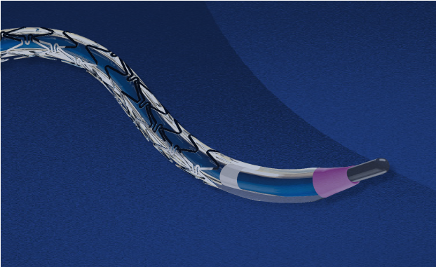 iVascular’s Restorer Stent Evaluated in Belgian BARISTA Study of ...