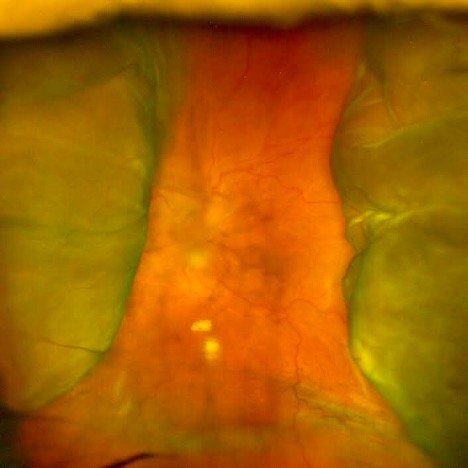 Study Shows Increase in Use of Anti-VEGF Injections - Modern Optometry