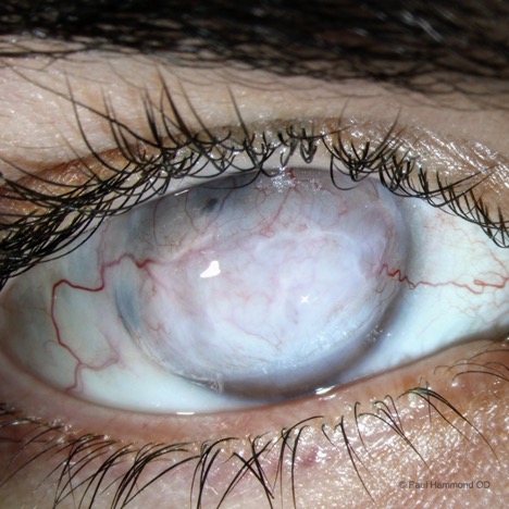 Decoding Color Vision - Modern Optometry