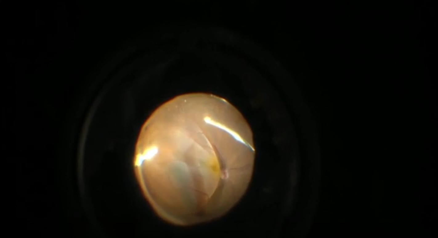 25-Gauge Vitrectomy for Chronic Bullous Exudative Retinal Detachment ...