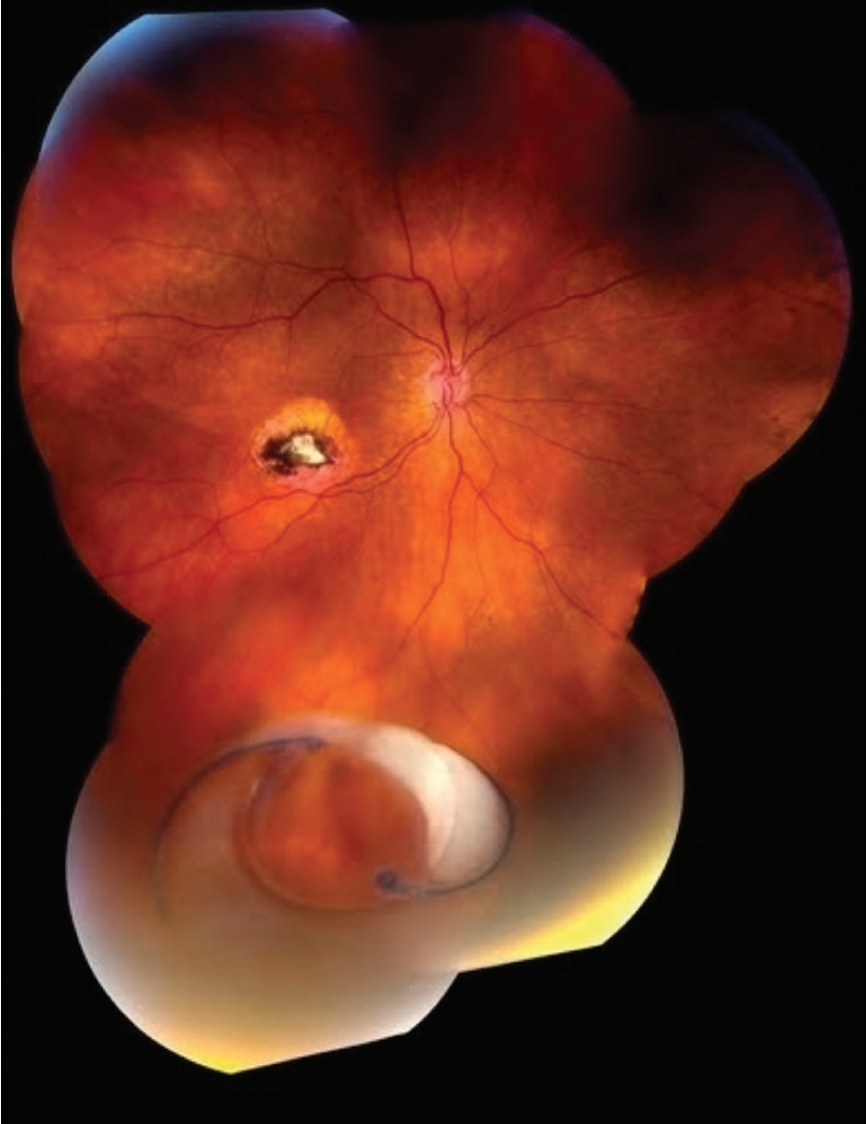 Tips for Repositioning Three-Piece IOLs - Retina Today
