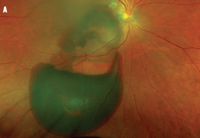 Better Surgeon Control for Submacular Hemorrhage Injection - Retina Today