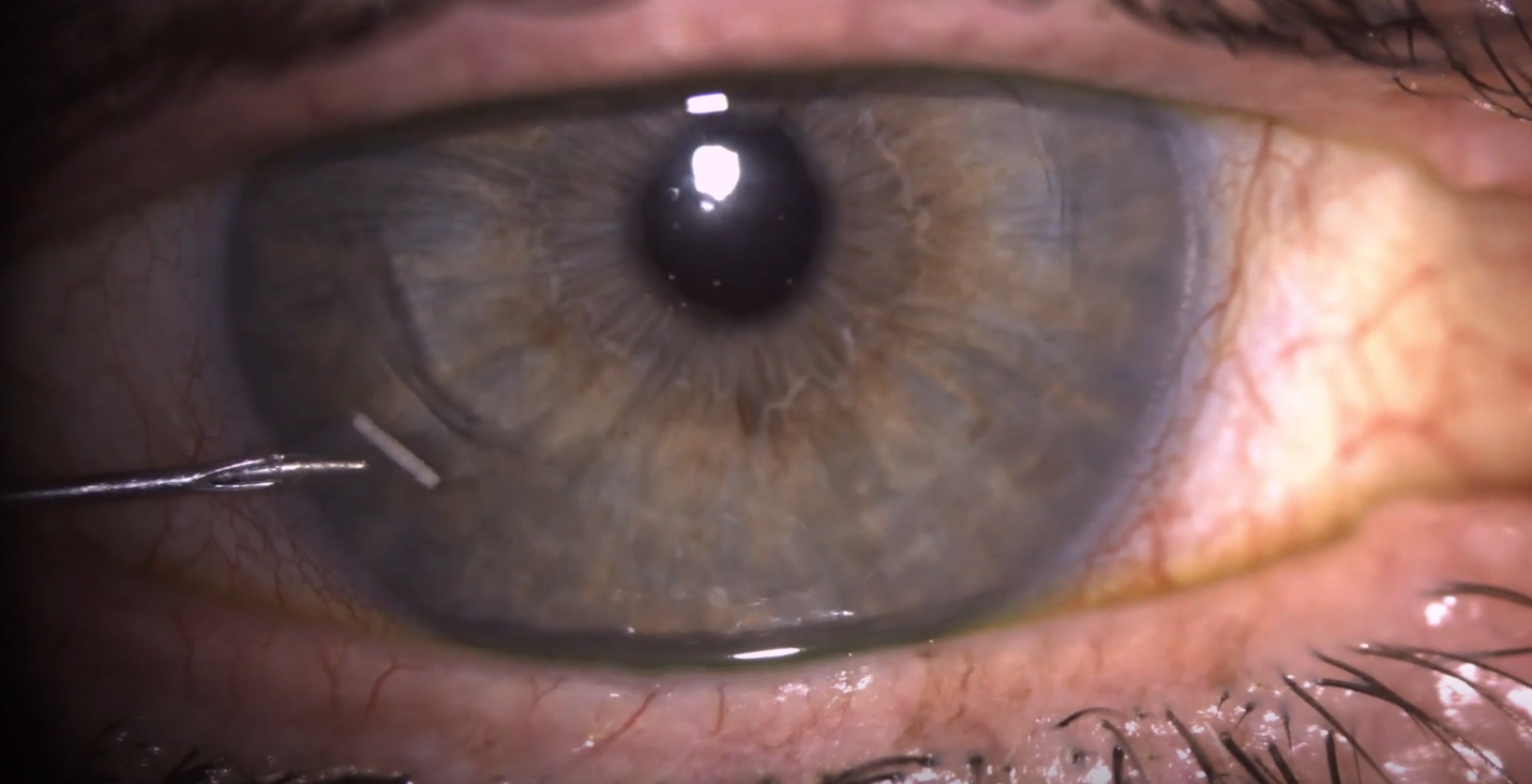 Durysta Injection Using the AC Probe - Eyetube