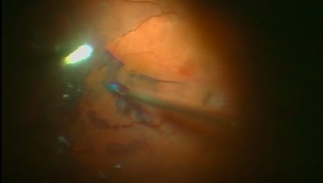 Core Vitrectomy With Epiretinal Membrane Removal - Eyetube
