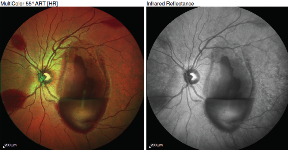 Valsalva Retinopathy and Crossfit Training - Retina Today