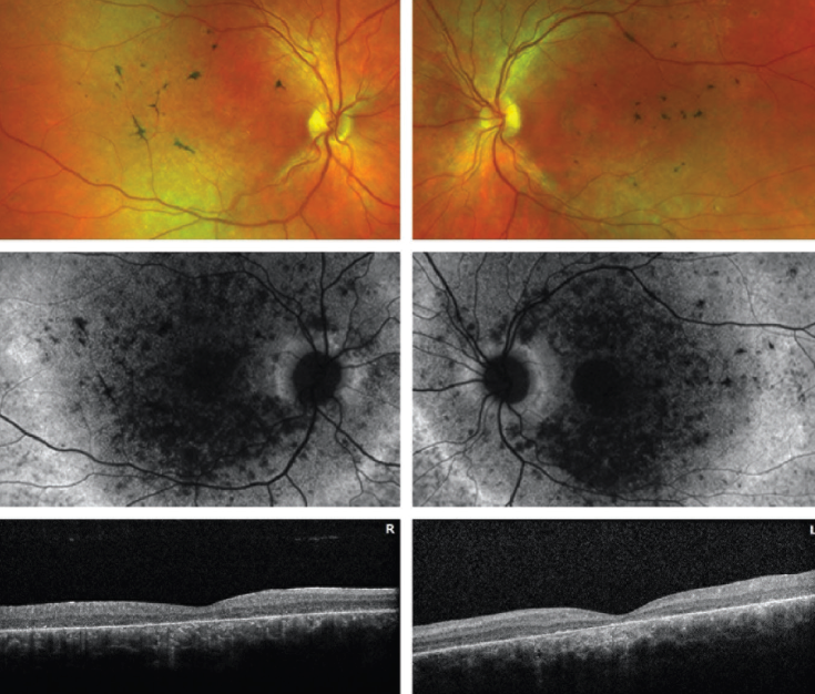Tips and Tricks for Evaluating Children for Inherited Retinal ...