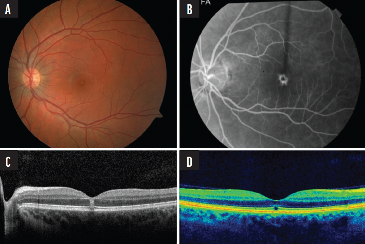 Solar Retinopathy: Eyes on an Eclipse - YoungMD Connect