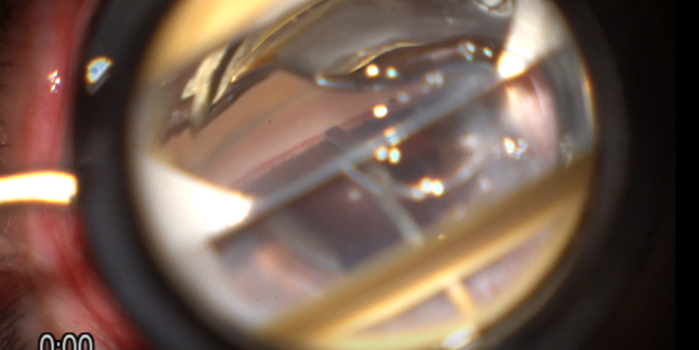 Gonio Sob Microscopio Learning MIGS? See How The OCULUS GONIO Ready®