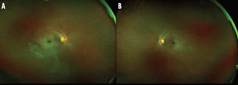 Ocular Blackout: A Harbinger of Sickle Crisis - Retina Today
