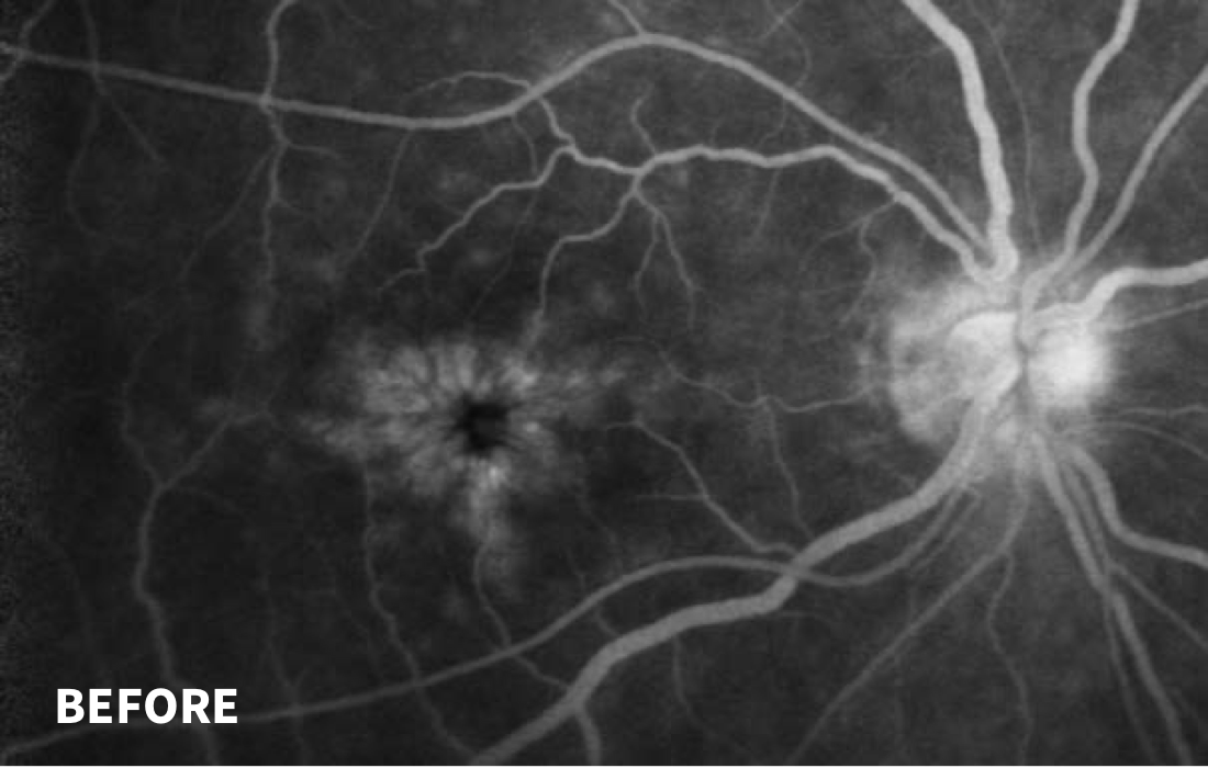 Chronic Posterior Uveitis, Irvine Gass Syndrome OD - Retina Today