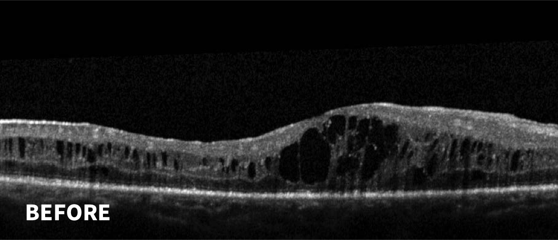 Chronic Posterior Uveitis, Irvine Gass Syndrome OD - Retina Today