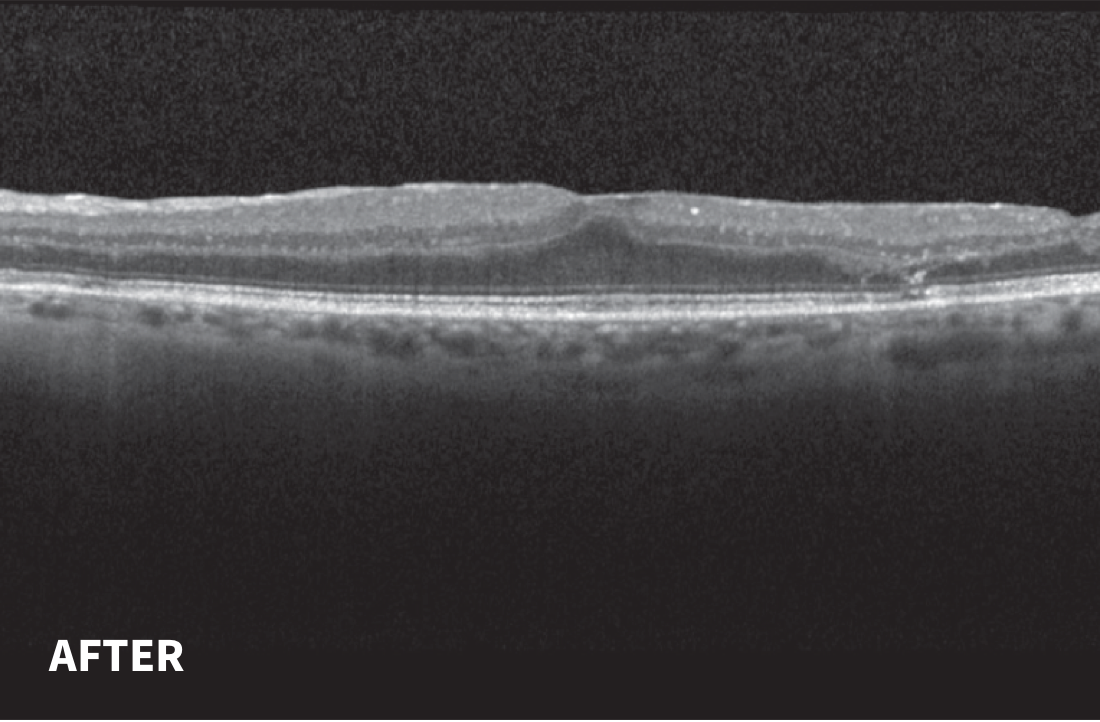 Chronic Postsurgical Posterior Uveitis With Macular Edema Os Retina Today