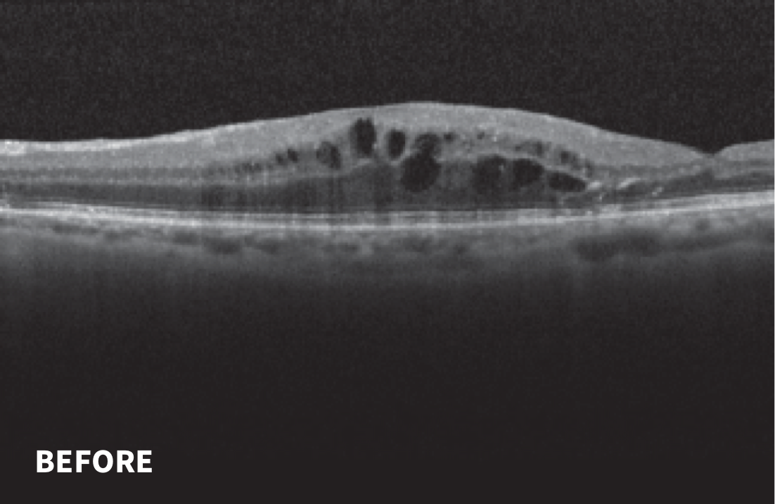 Chronic Postsurgical Posterior Uveitis With Macular Edema OS - Retina Today