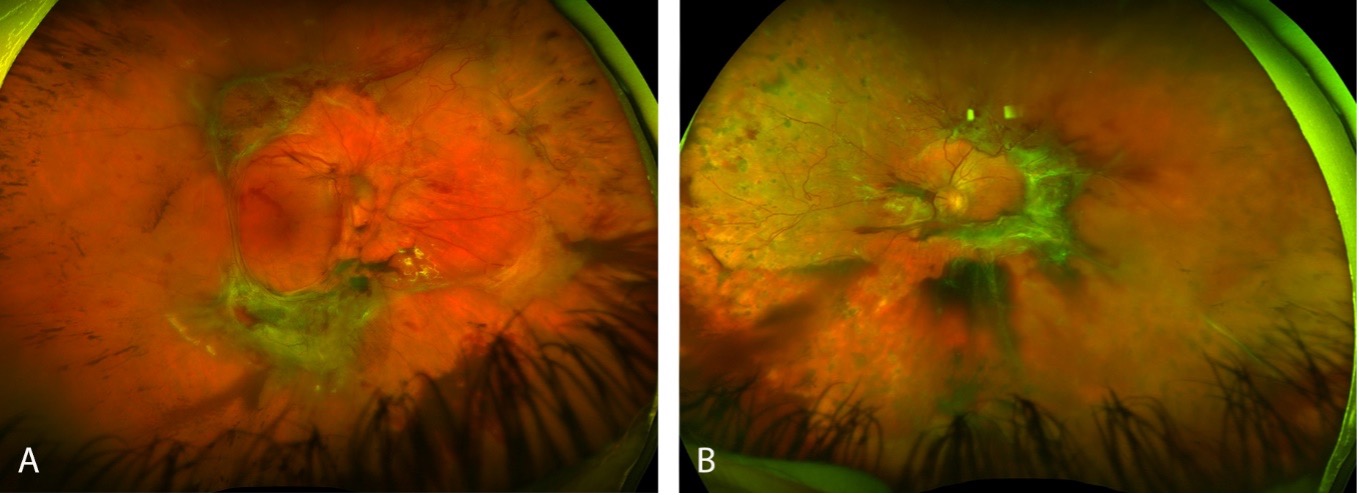 Managing DR One Case at a Time - Retina Today