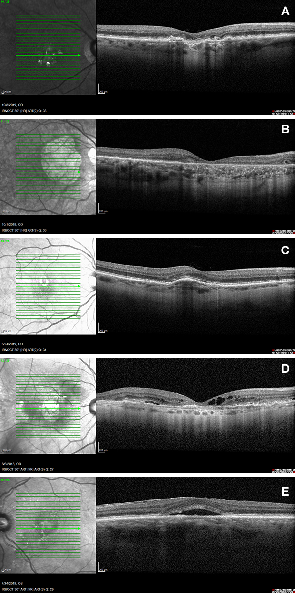 Imaging Basics in AMD - Retina Today