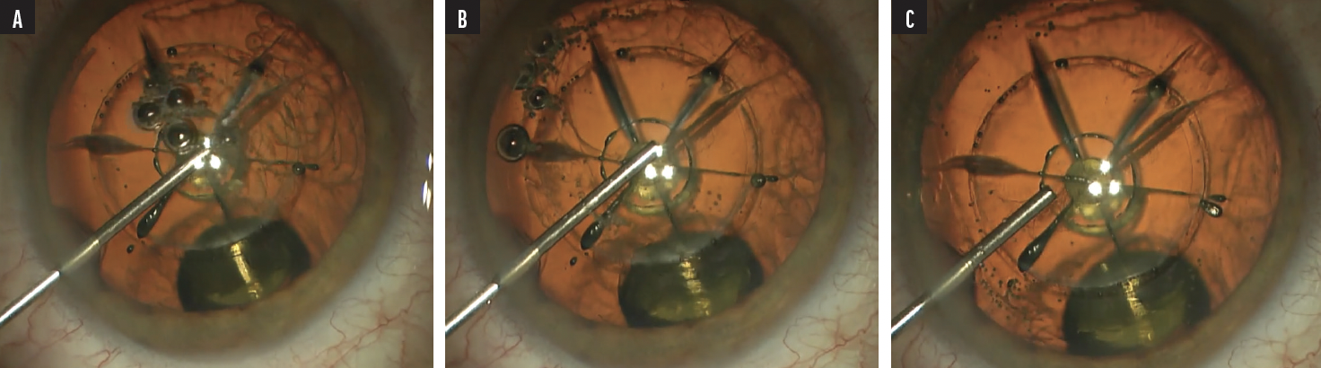 Mitigating Challenging Surgery With DuoVisc - YoungMD Connect