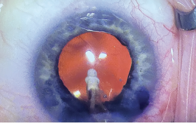 Mitigating Challenging Surgery With DuoVisc - YoungMD Connect