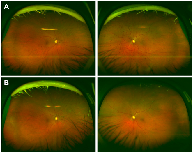 Working With Patients to Manage Diabetic Eye Disease - Retina Today