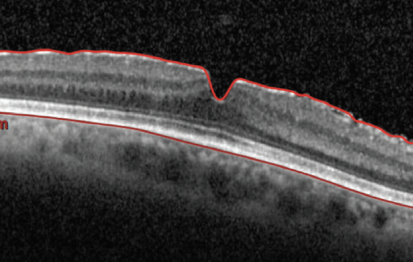 Vitreous Opacities - Retina Today