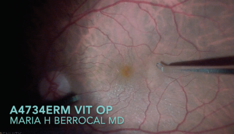 Vitreous Opacities - Retina Today