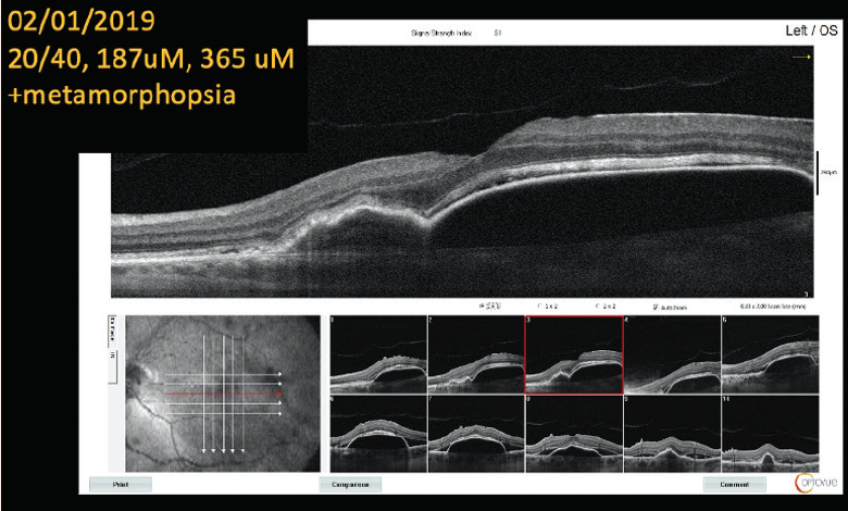 The Art of Drug Choice - Retina Today
