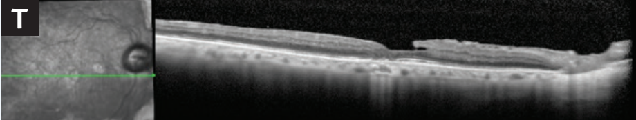 Perspectives on Treatment With OZURDEX (dexamethasone intravitreal ...