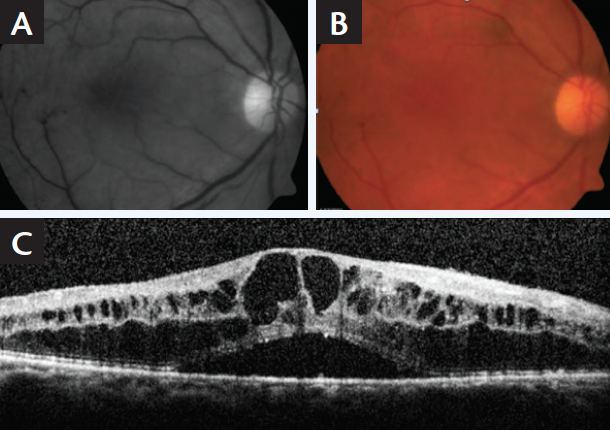 Case 2: OZURDEX in a Case of DME - Retina Today