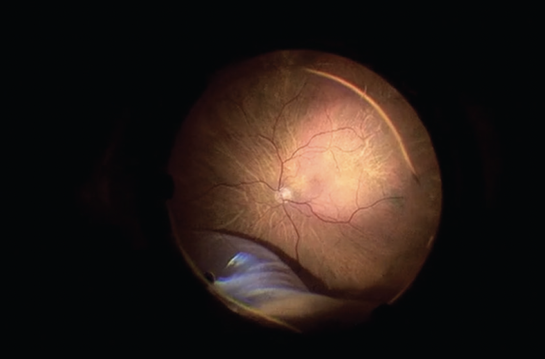 Case No. 2: Simplifying Surgery With CryoTreq - Retina Today