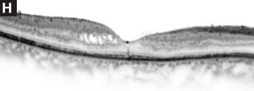 Perspectives on Treatment With OZURDEX (dexamethasone intravitreal ...