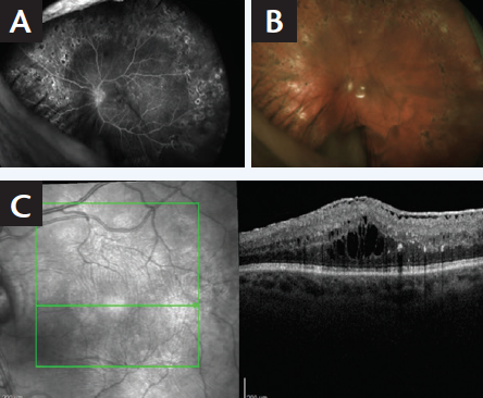 Case 3: OZURDEX in a Case of DME - Retina Today