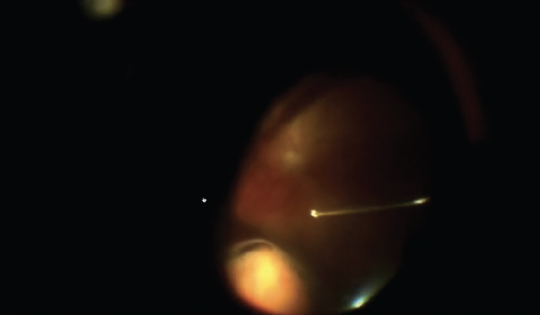 Case No. 3: Cryotherapy With CryoTreq - Retina Today