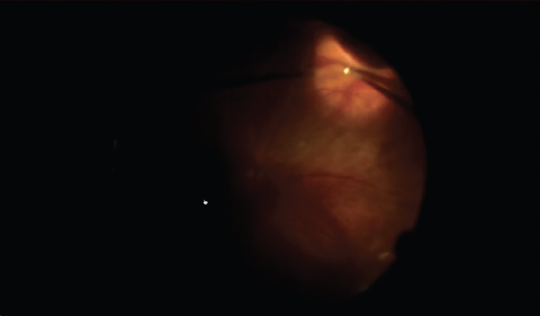 Case No. 3: Cryotherapy With CryoTreq - Retina Today