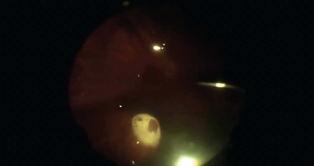 Case No. 3: Cryotherapy With CryoTreq - Retina Today