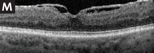 Perspectives on Treatment With OZURDEX (dexamethasone intravitreal ...