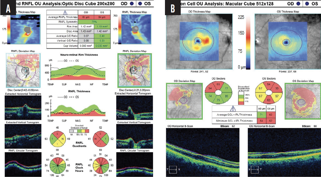 Traumatized by Aqueous Misdirection - Glaucoma Today