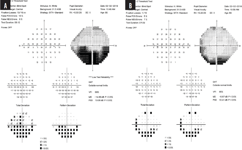 Traumatized by Aqueous Misdirection - Glaucoma Today