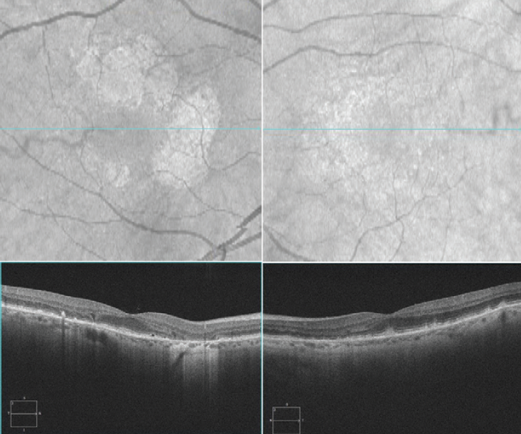 Case NO.2: Tracking Lesion Growth with the ZEISS Retina Workplace - Retina Today