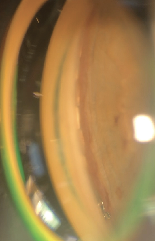 Recurrent Hyphema - Glaucoma Today